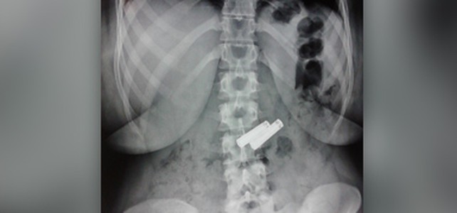 L’ingestion de piles : une urgence thérapeutique